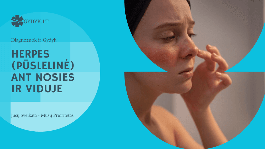 Herpes (pūslelinė) ant nosies ir viduje: kaip atpažinti ir gydyti ...