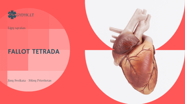 Fallot tetrada: priežastys, simptomai ir diagnostika - Gydyk.lt